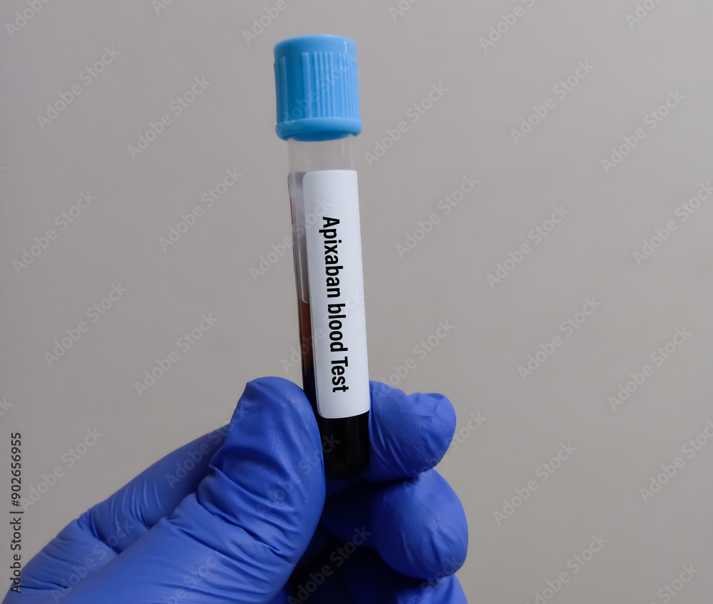 Blood sample for Apixaban level test. Measurement of drug level in ...