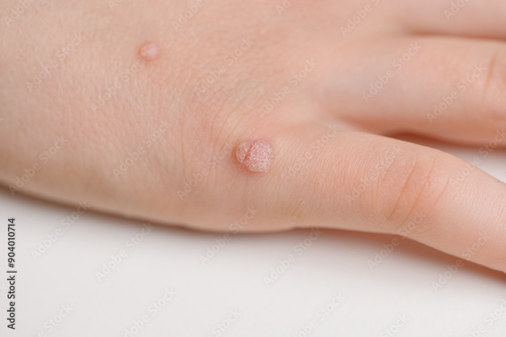 Wart on child hand. Close-up of warts on child hand. Common wart Verruca vulgaris caused by type ...