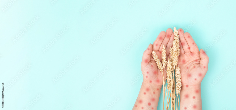 Gluten intolerance, celiac disease or wheat allergy, skin rash on the ...
