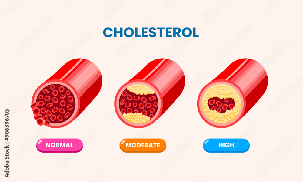 Comparison of normal blood flow and blood vessels with cholesterol ...