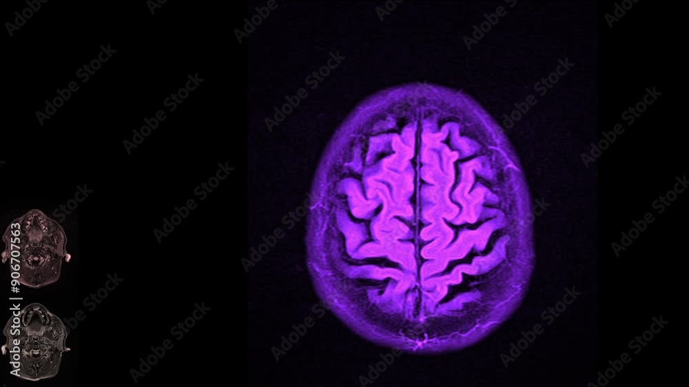 Magnetic Resonance Imaging Of The Brain Mri Of The Brain Medical Examination Of The Human