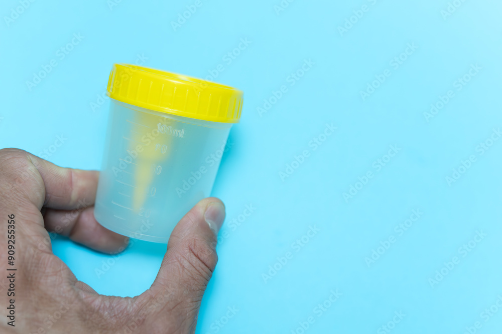 Hand held medical urine test bottle, plastic cup with yellow ...