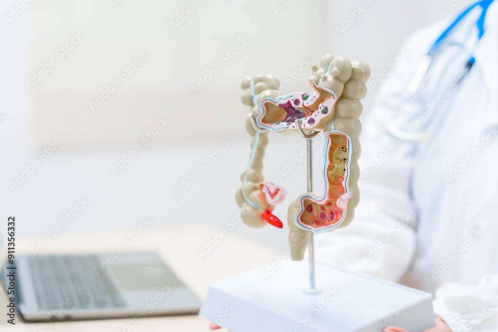 A doctor holds a human colon anatomy model, demonstrating the digestive ...