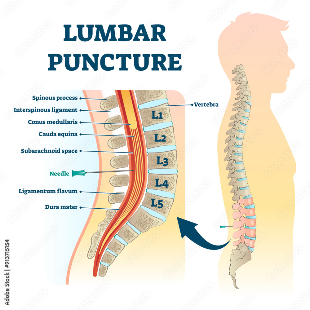 Lumbar puncture illustration, transparent background. Labeled spinal ...