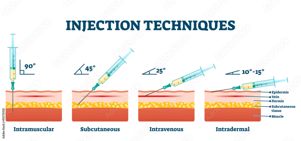 Injection techniques illustration, transparent background.Labeled ...
