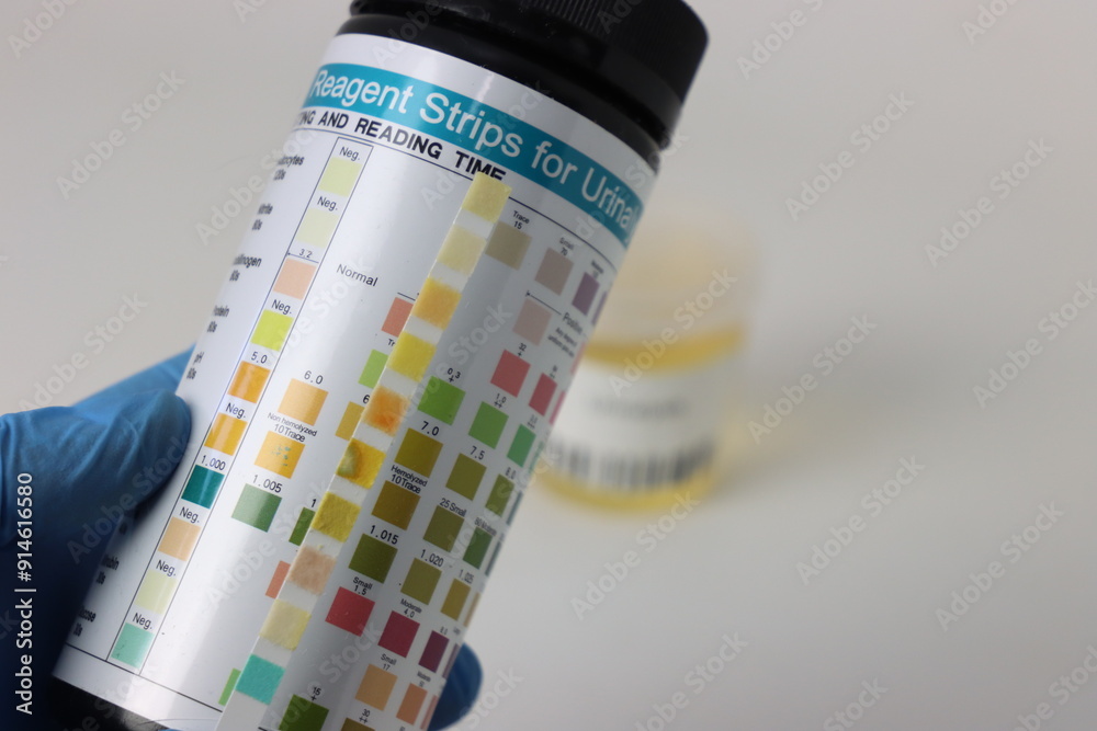 Professional holding the reagent strips for urinalysis and the reading ...
