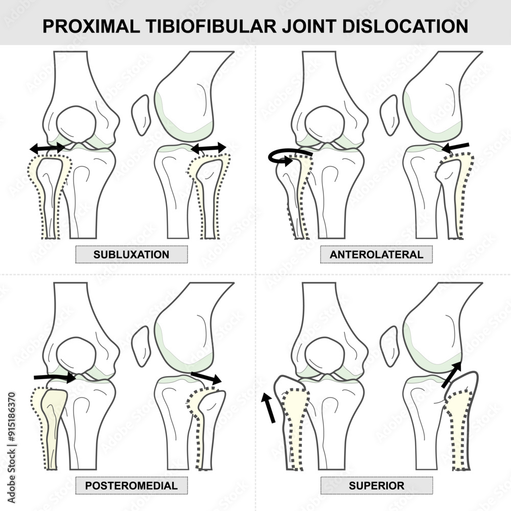 Proximal Tibiofibular Joint Dislocation illustration Stock Vector ...