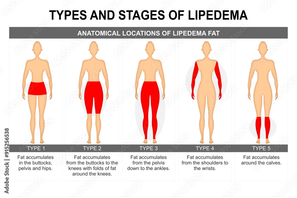 Types and Stages of Lipedema Stock Illustration | Adobe Stock