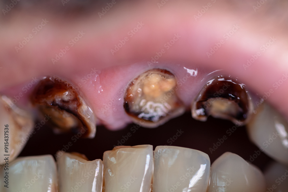 Man without front upper teeth. Rotten front teeth. Roots of teeth with ...