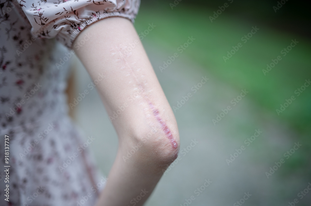 Surgical Scar on the Right Young Teen Hand. Scar Caused by Hand Surgery ...