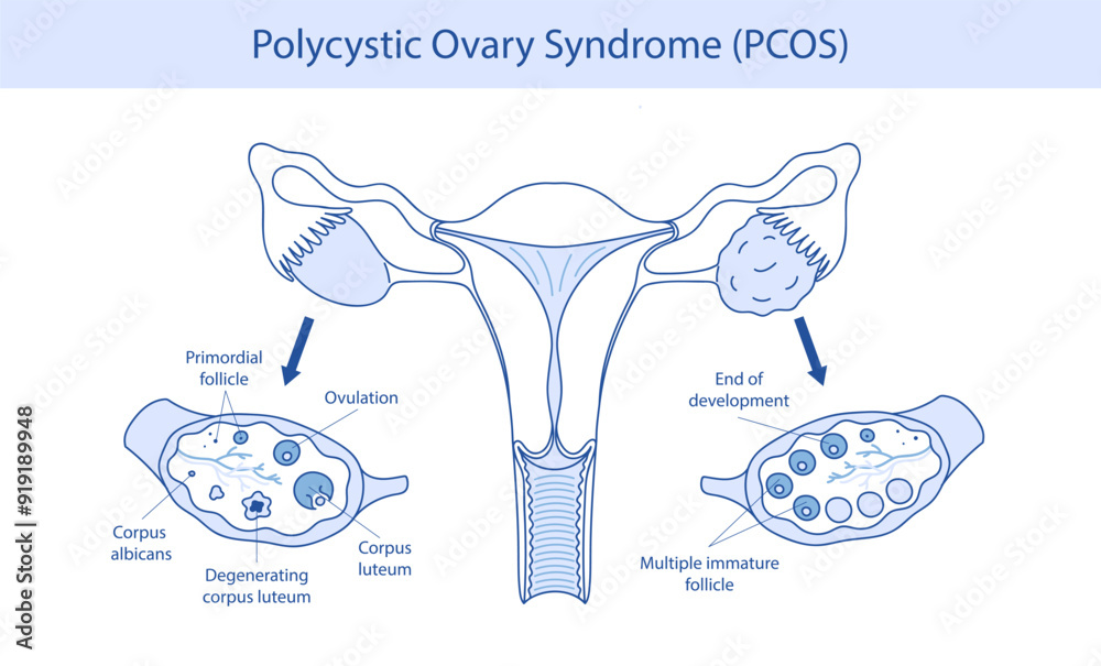 Polycystic ovary syndrome PCOS. Ovarian cysts of the female ...