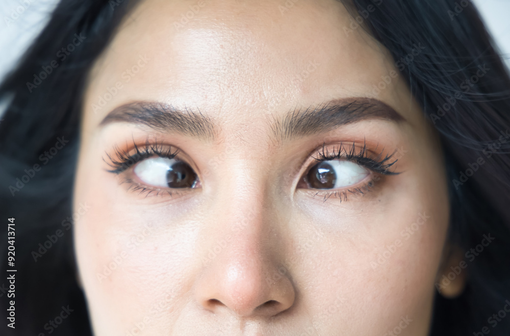 woman suffering from strabismus, bulging eye, hyperthyroidism, graves ...