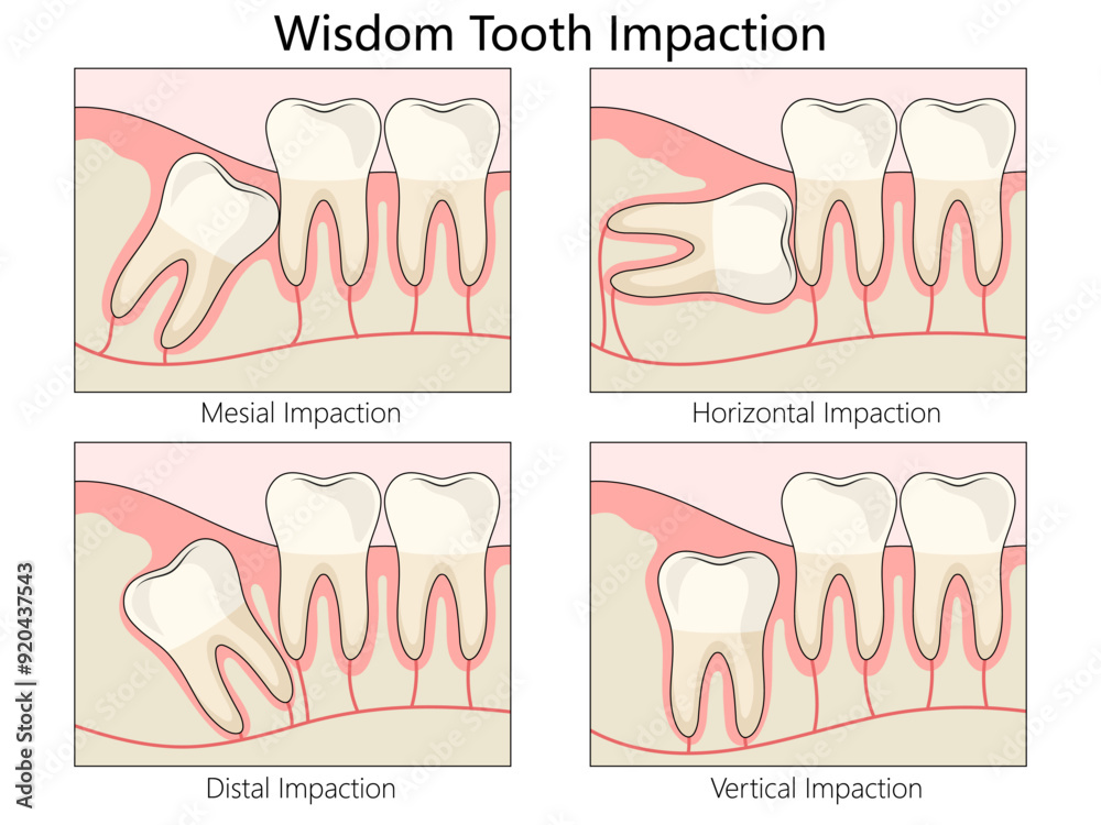 wisdom tooth impaction. mesial, horizontal, distal, and vertical ...