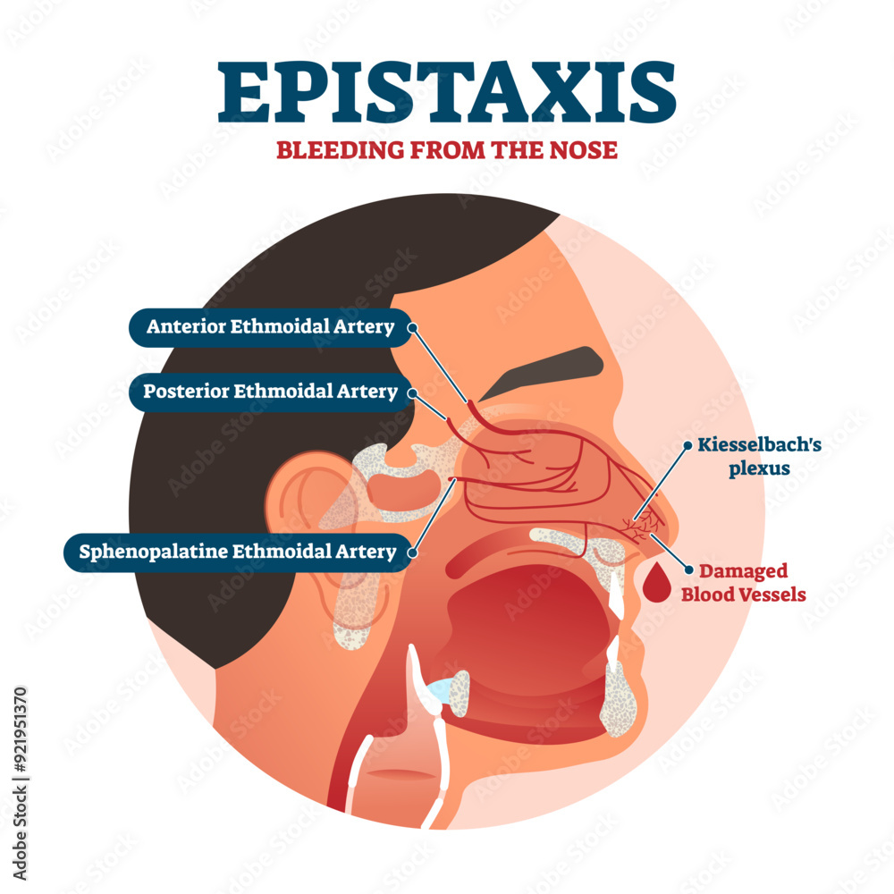 Epistaxis illustration, transparent background. Labeled bleeding from nose explanation health ...