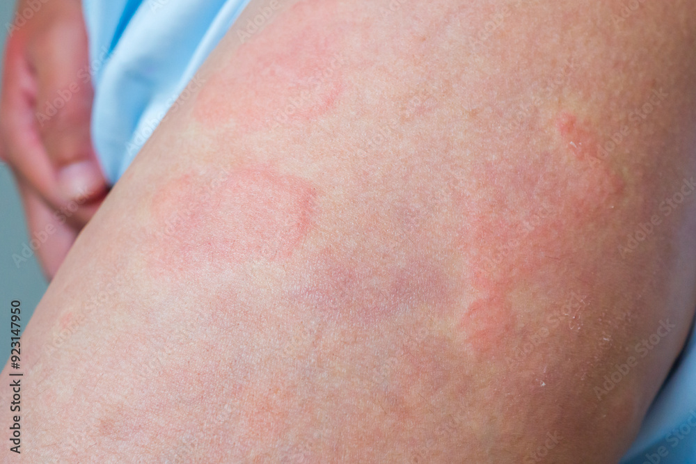 Young asian man has allergic skin rash on his legs from itchy dry skin ...