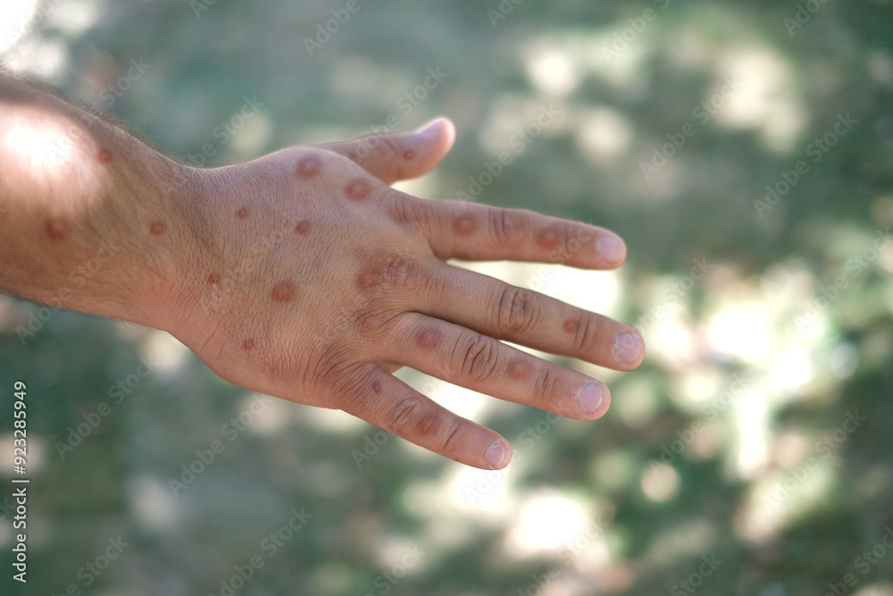 Men's hands showing rash due to Pox viral infection Painful red ...