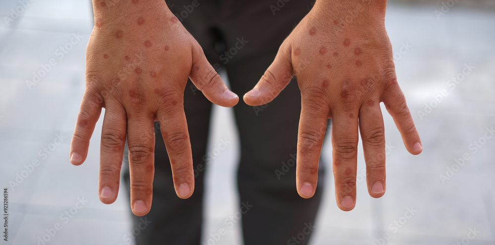 Men's hands showing rash due to Pox viral infection Painful red ...