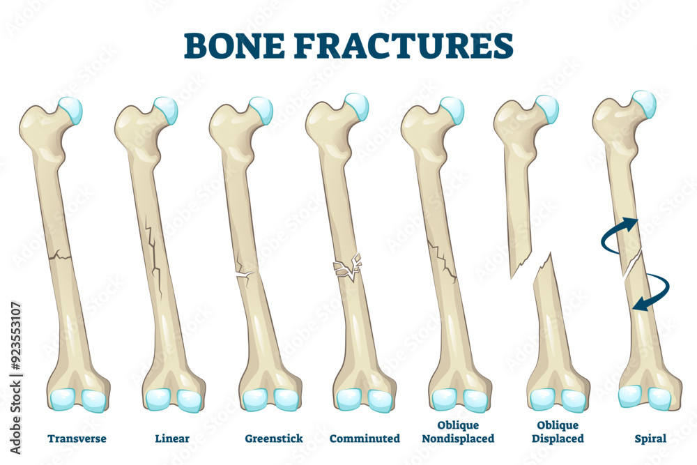 Bone fractures illustration, transparent background. Educational ...