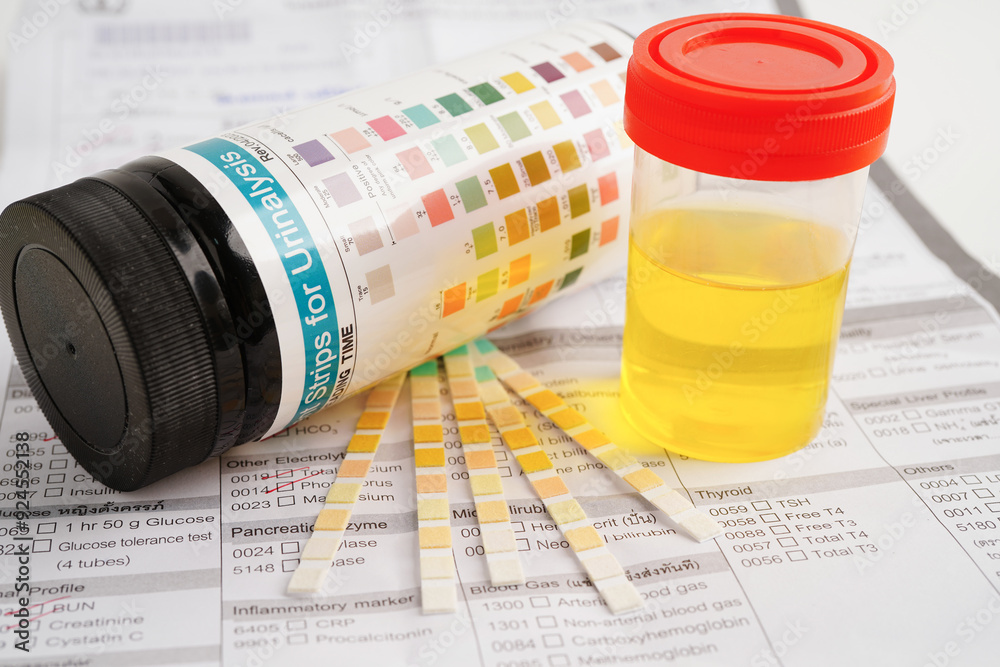 Urinalysis, urine cup with reagent strip pH paper test and comparison ...