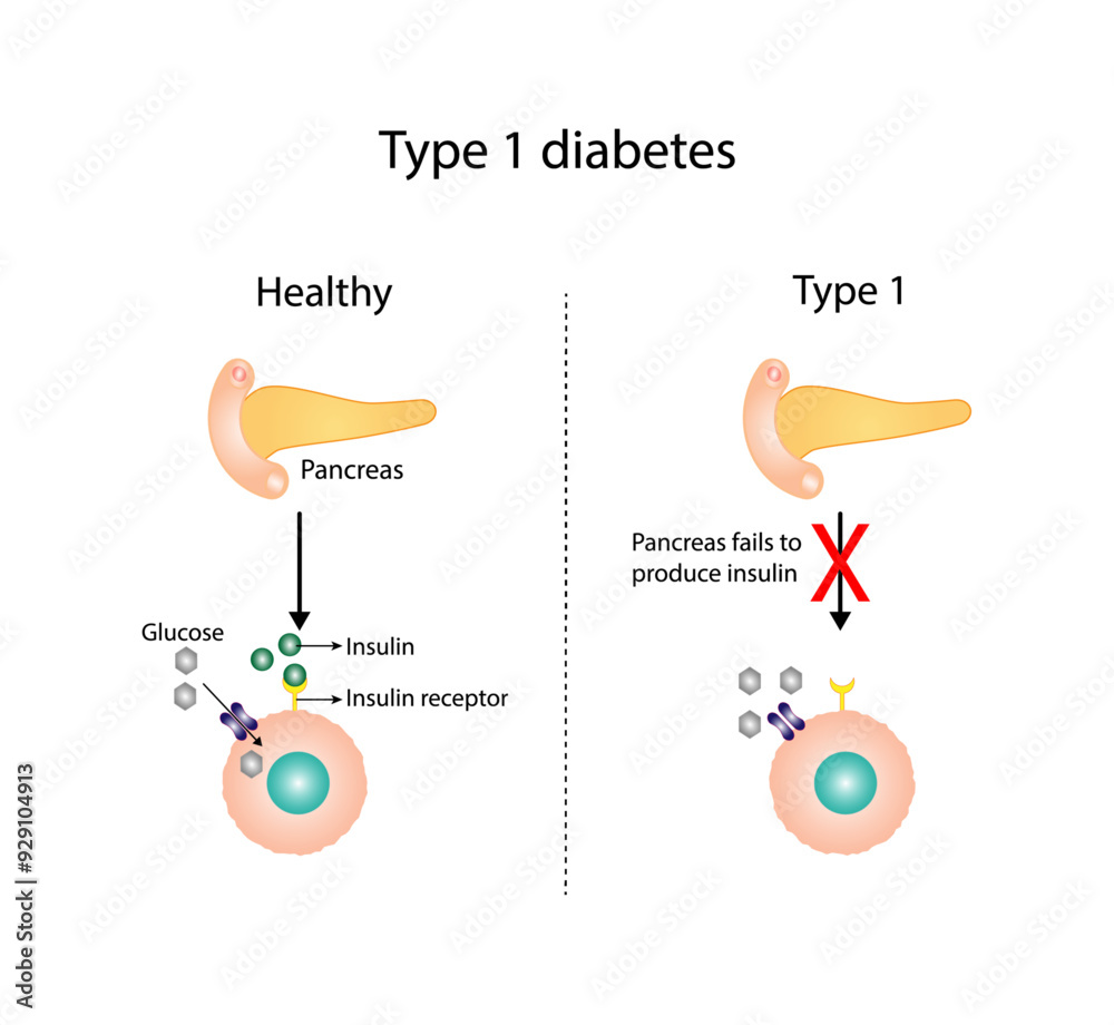Diabetes mellitus type 1, pancreas's failure to produce enough insulin ...