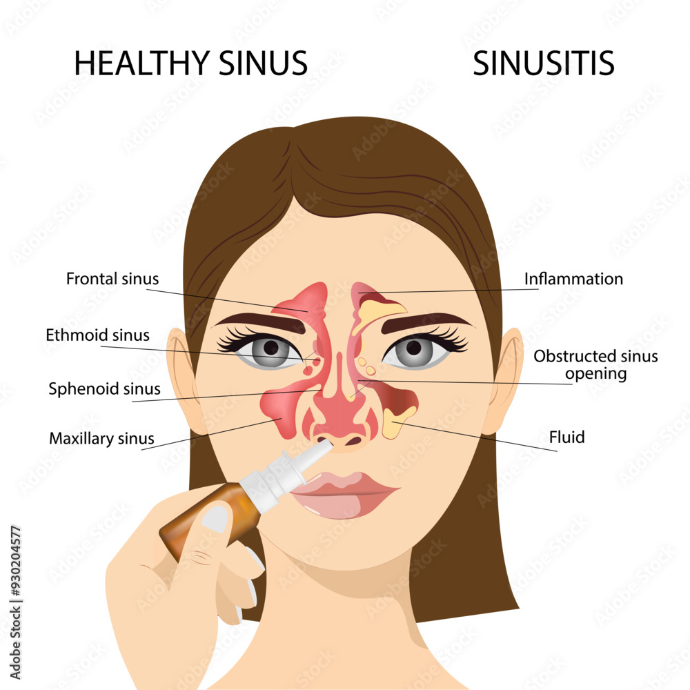 Sinusitis, Female face with inflammation of the mucous membrane of the ...