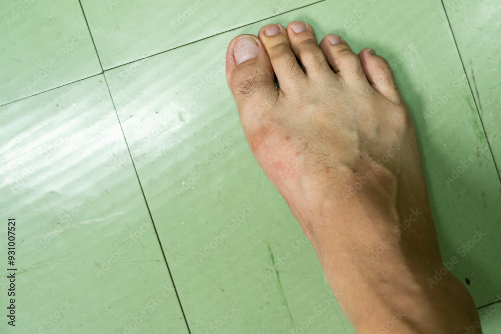 Allergic rash dermatitis eczema skin of patient. Foot in scratching ...