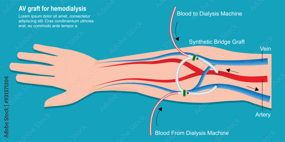 An arteriovenous (AV) graft is a type of access used for hemodialysis ...