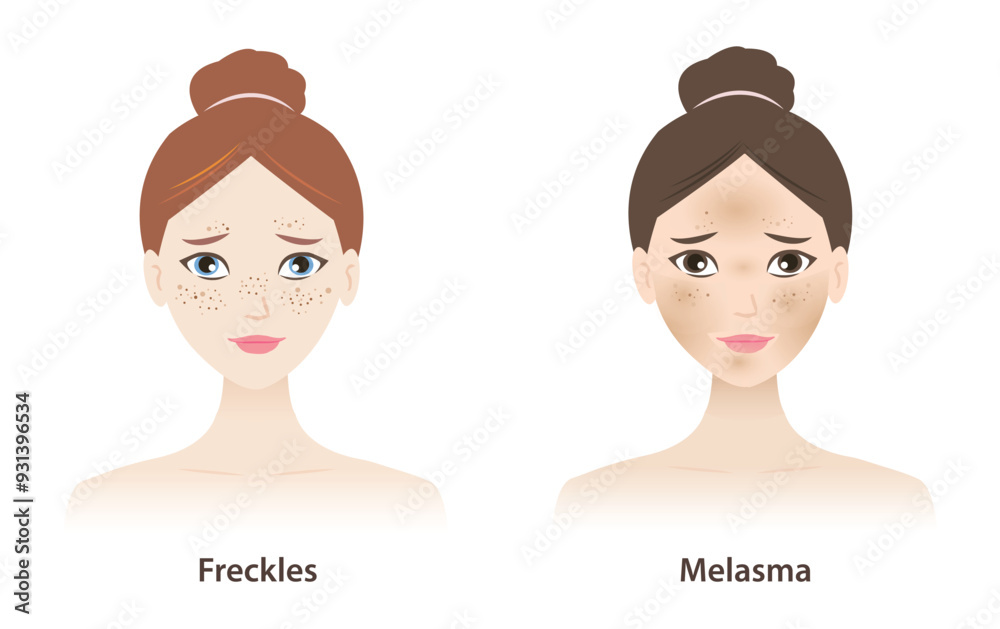 The women with freckles and melasma on skin face vector illustration ...