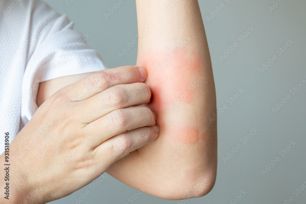 Young asian man itching and scratching on arm from allergic itchy dry ...