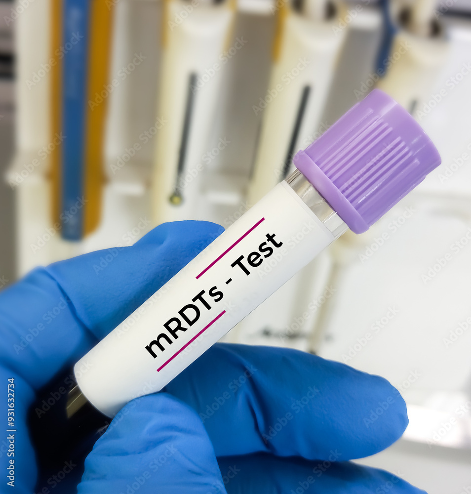 Blood test sample for mRDT or malaria rapid diagnostic test. Histidine ...