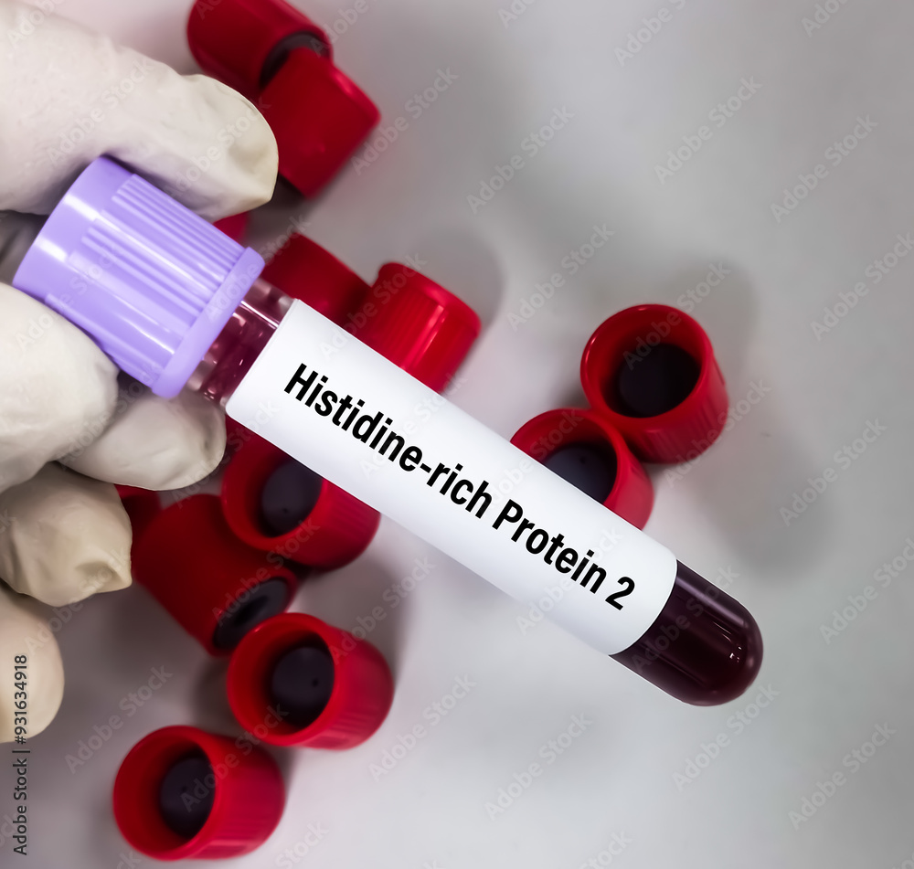 Blood sample for Histidine Rich protein II (HRP2) test, to diagnose ...
