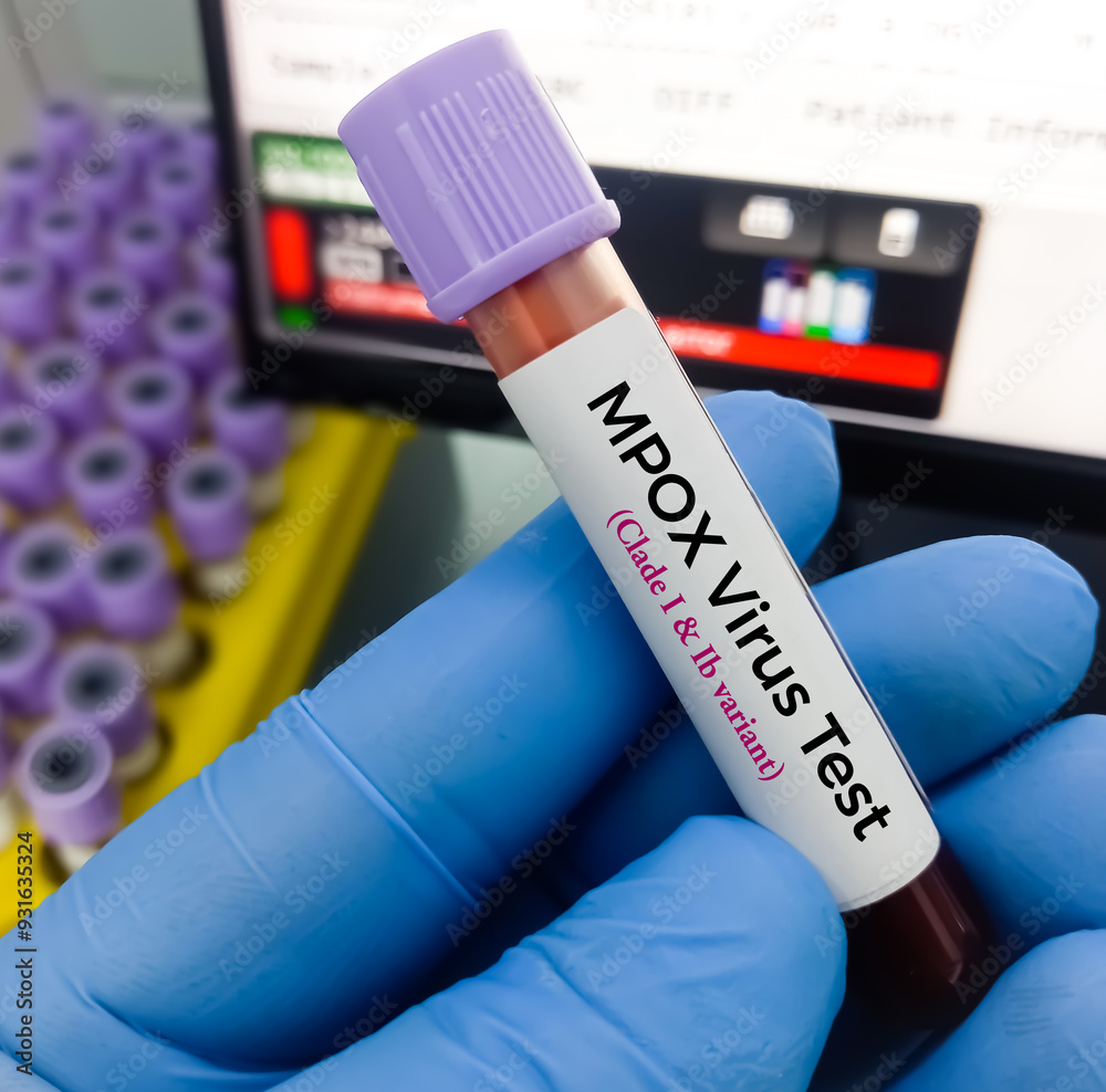 Blood test sample for monkey pox virus (MPXV) test. Mpox (formerly ...