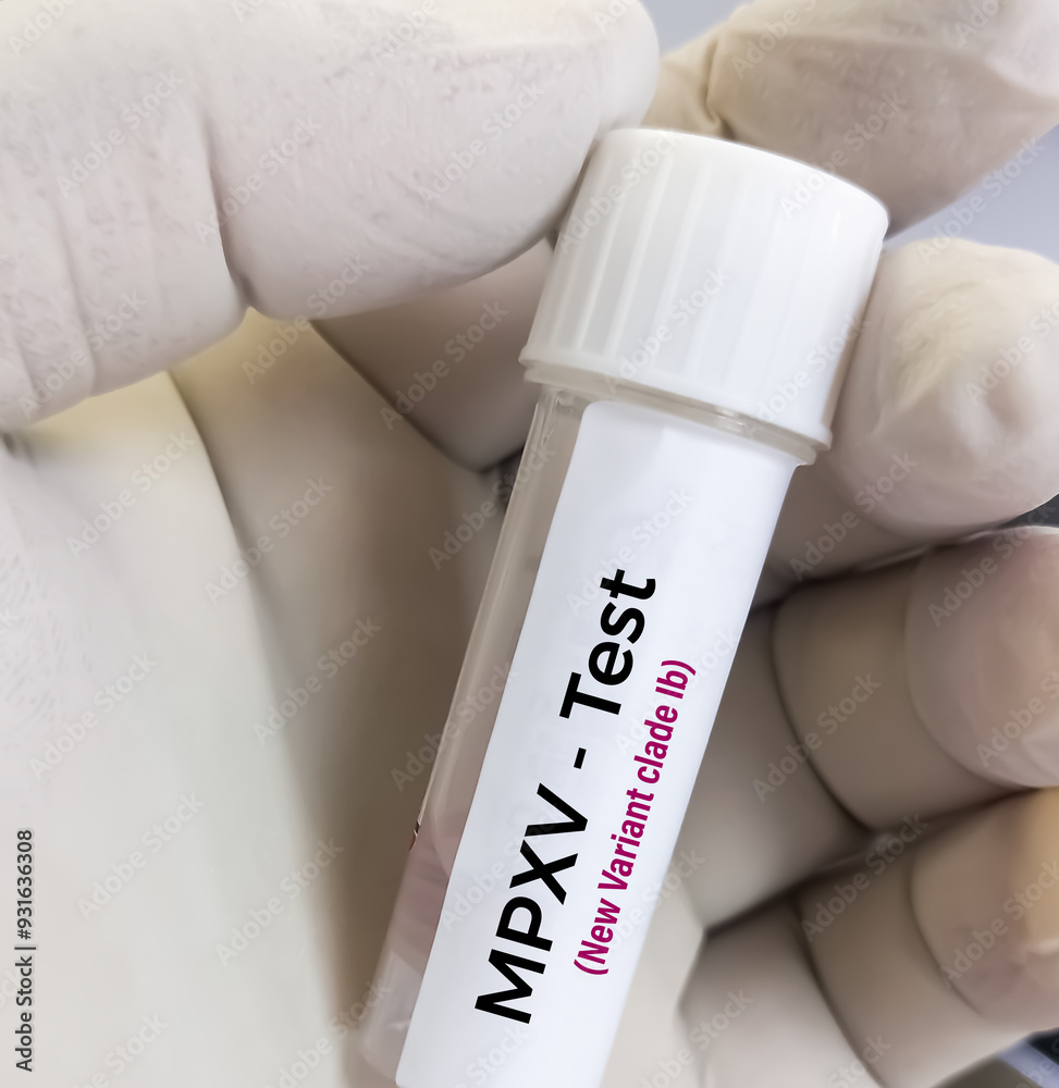 Blister swab or nasal swab sample for monkey pox virus (MPXV) test ...