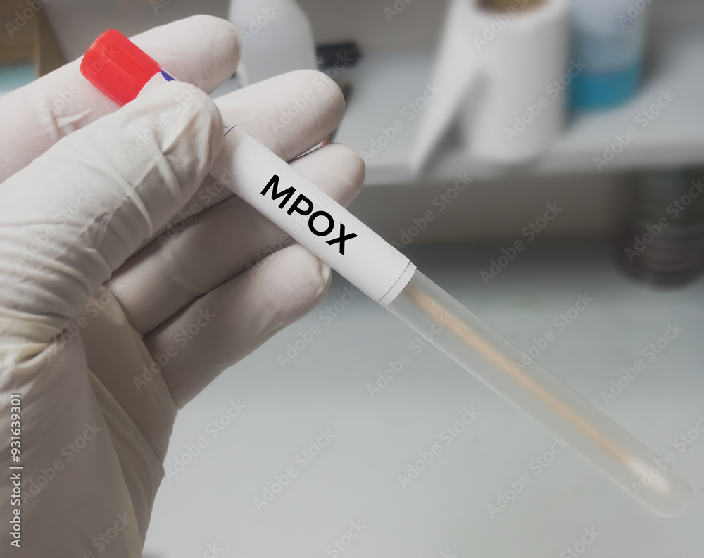 Blister swab or nasal swab sample for monkey pox virus (MPXV) test ...