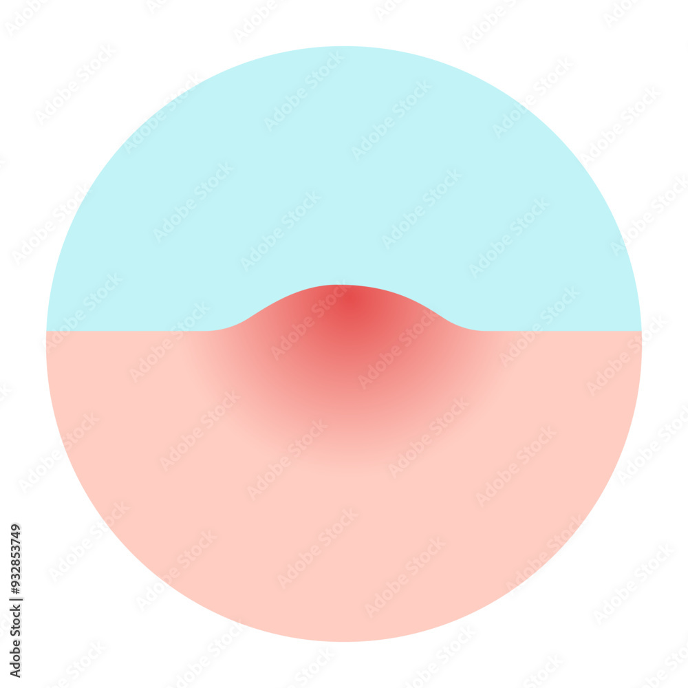 mpox, monkey pox disease. stage 2 papule of Mpox skin symptom Stock ...