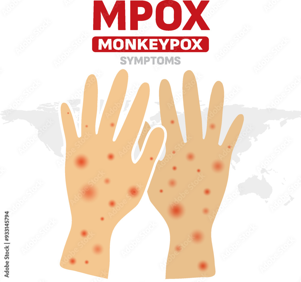 Infected person's hands with Mpox monkeypox virus. Illustration of ...