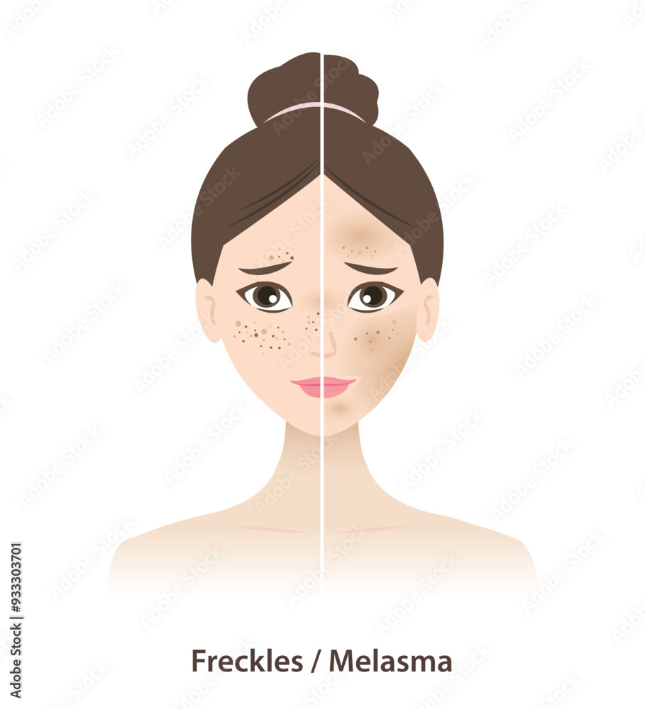 Comparison of freckles and melasma on skin woman face vector ...
