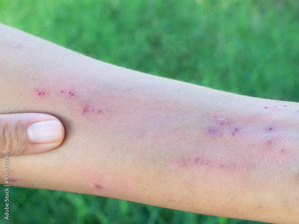 Hand with urticaria allergy itchy rash eczema itch woman from food ...