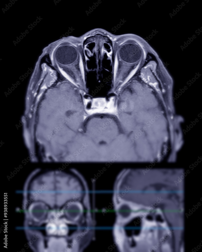 Image of MRI orbit scan with gadolinium contrast in normal case ...