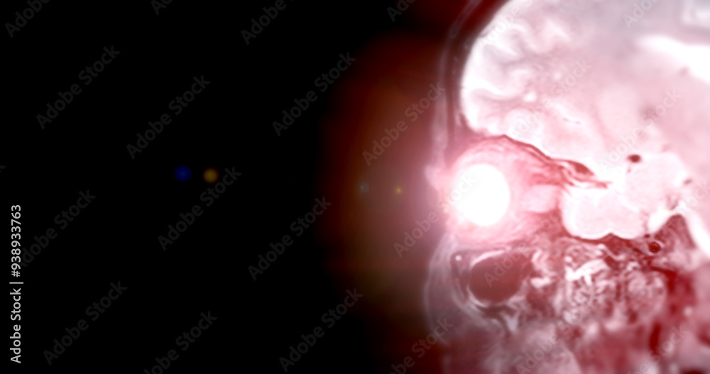 Image of MRI orbit scan with gadolinium contrast in normal case ...