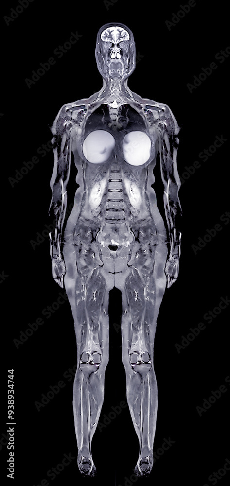 MRI whole body scans are beneficial for early cancer detection, monitoring chronic conditions ...