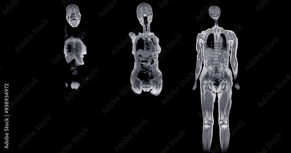 MRI whole body scans are beneficial for early cancer detection, monitoring chronic conditions ...