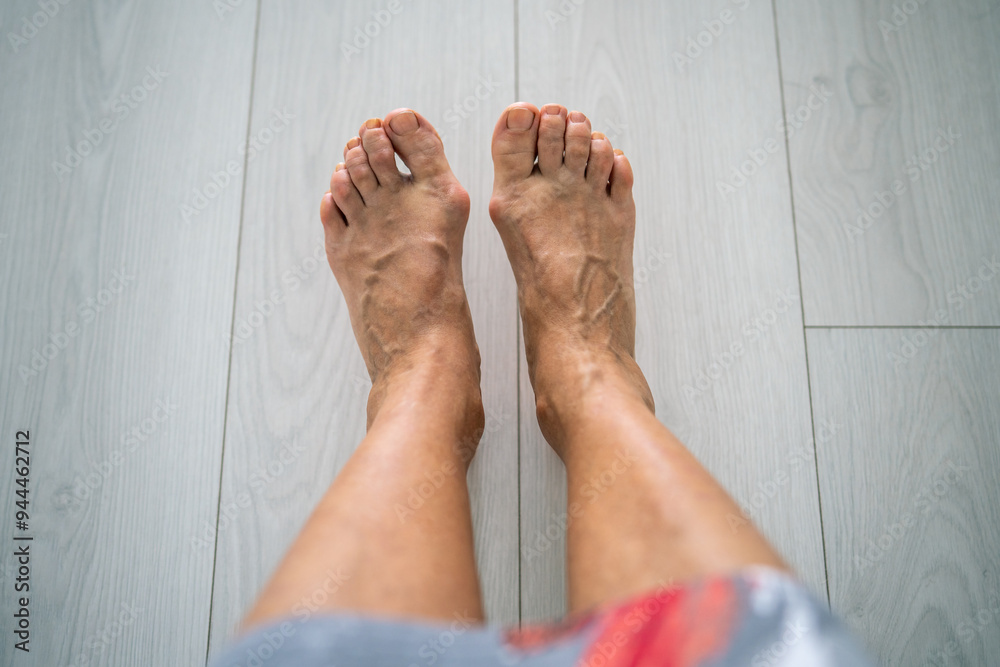 Cropped elderly woman varicose bare feet with growth, valgus deformity ...