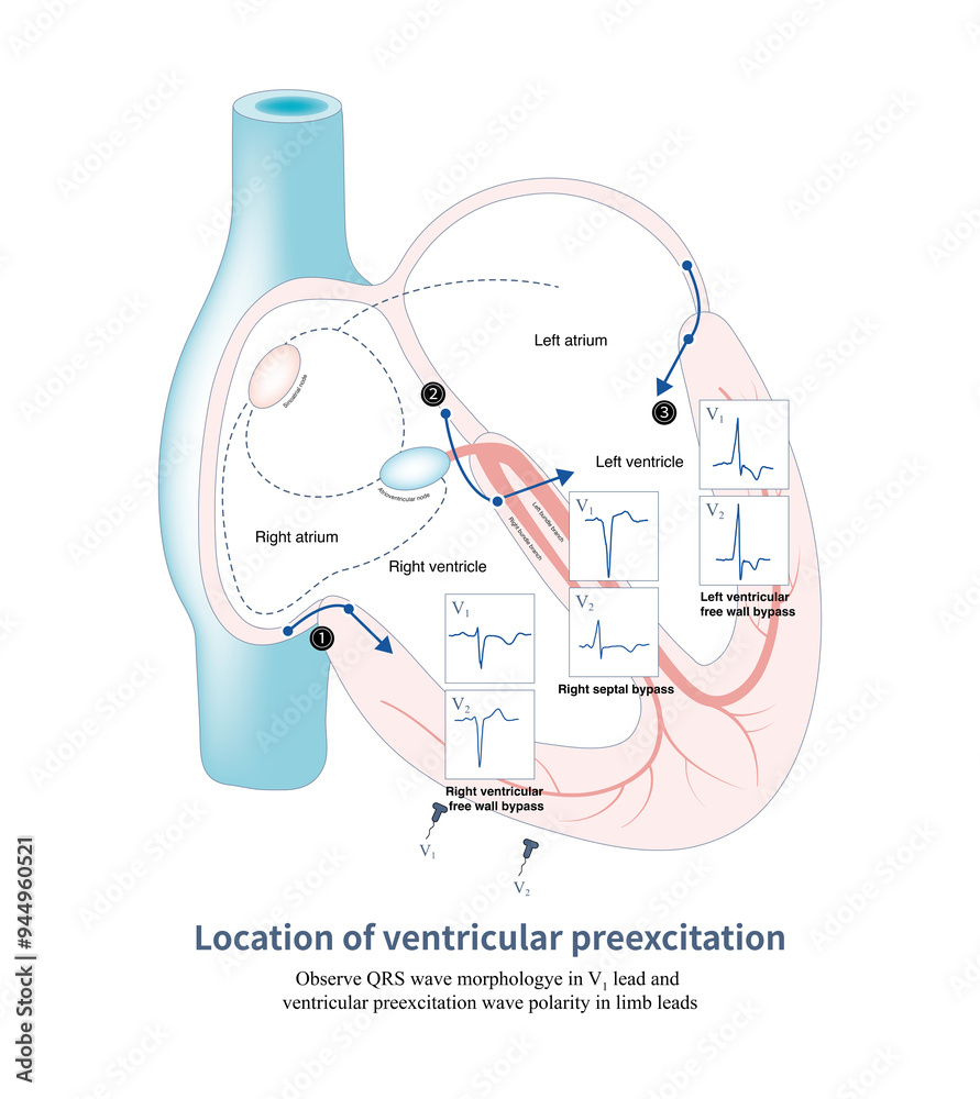 Póster On the electrocardiogram, observing the morphology of QRS waves ...