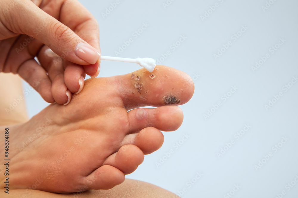 Girl applying ointment to a wart on her toe. Treatment of plantar warts ...
