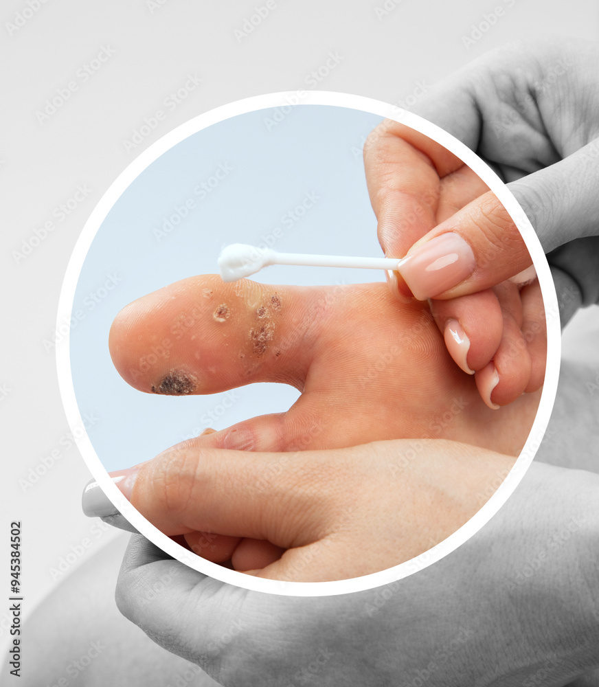 Girl applying ointment to a wart on her toe. Treatment of plantar warts ...