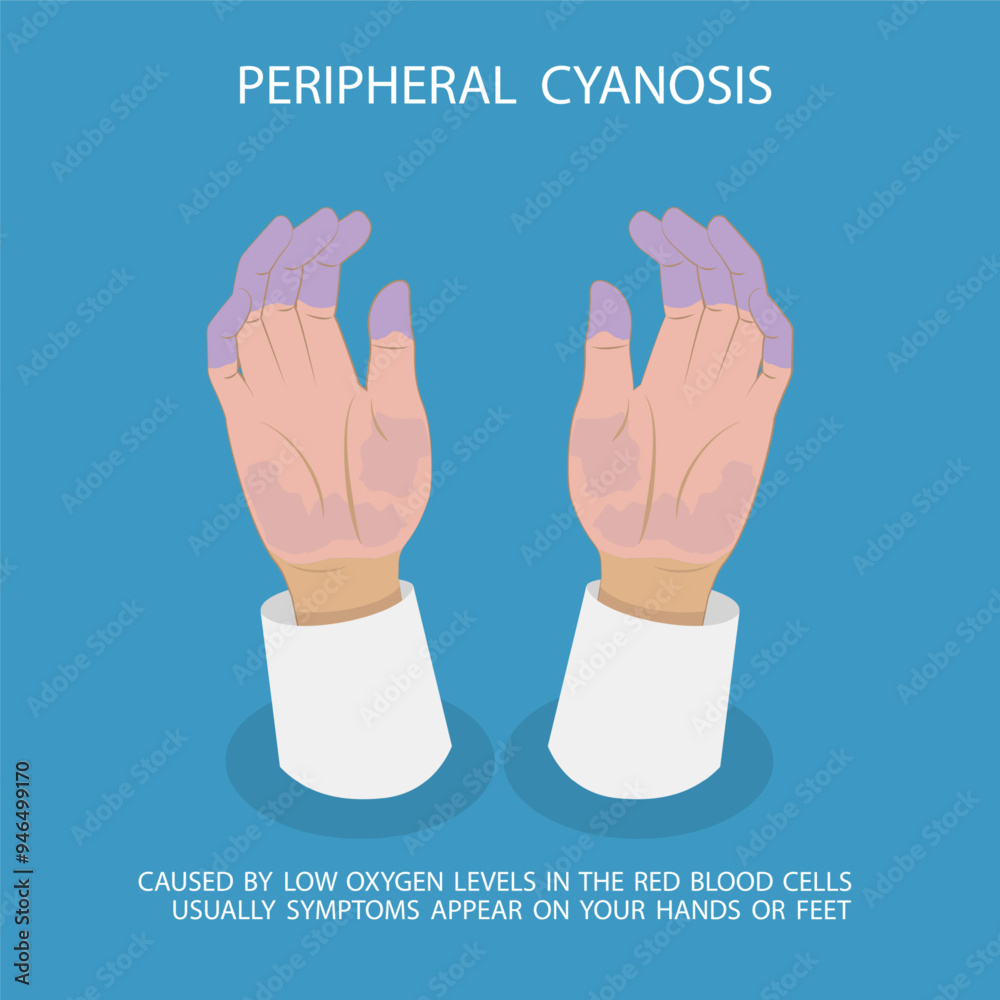 3D Isometric Flat Vector Illustration of Peripheral Cyanosis Symptoms ...