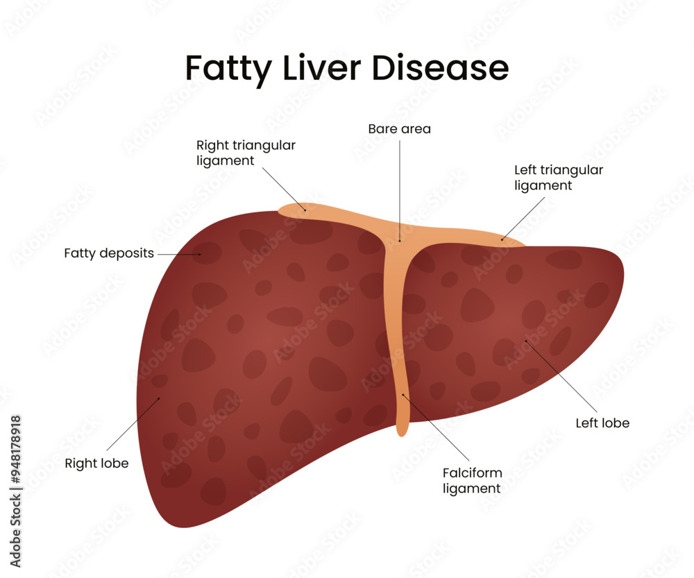 Symptoms of Fatty Liver Disease Stock Vector | Adobe Stock