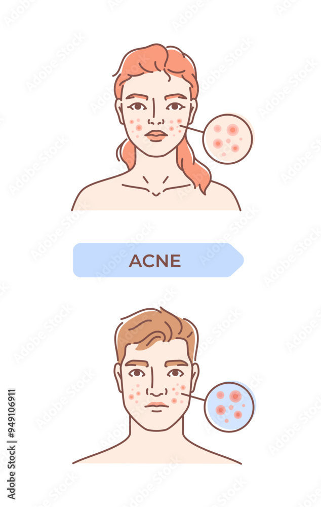 Skin condition infographics. Man and woman with acne skin. Problems and ...
