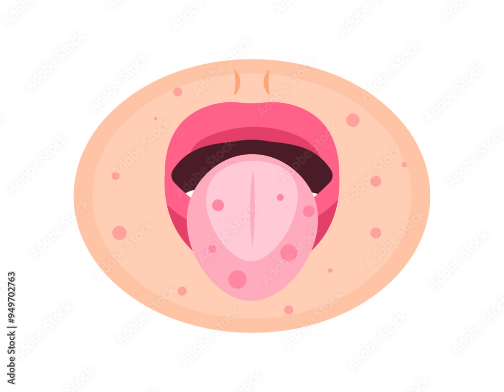 illustration of tongue and cheeks covered with rashes and sores. red ...